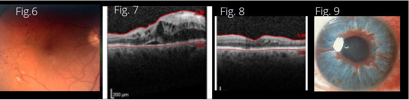 THE KUMAR EYE CHRONICLE Q3 2021 – Kumar Eye Institute